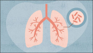 Stages of COPD Chart: Tracking Progression of Chronic Lung Disease ...