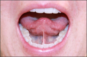 Tongue Tie vs Normal Tongue: Recognizing the Difference – Health and ...